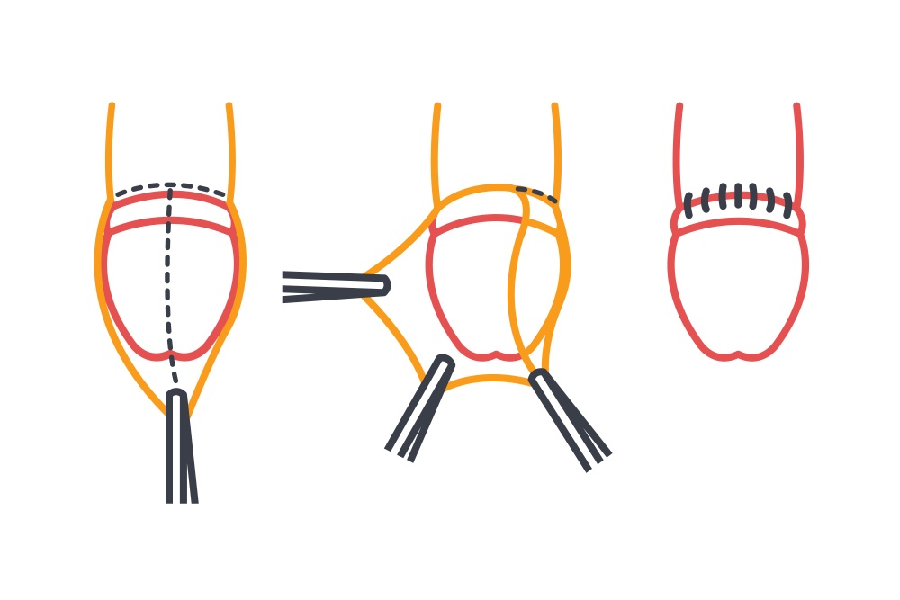 Circuncisao Infantil Antes E Depois Entenda O Que é Hipospádia